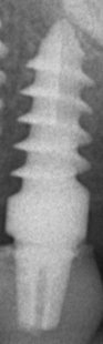 Trinon Titanium Q Implant dentaire | SpotImplant