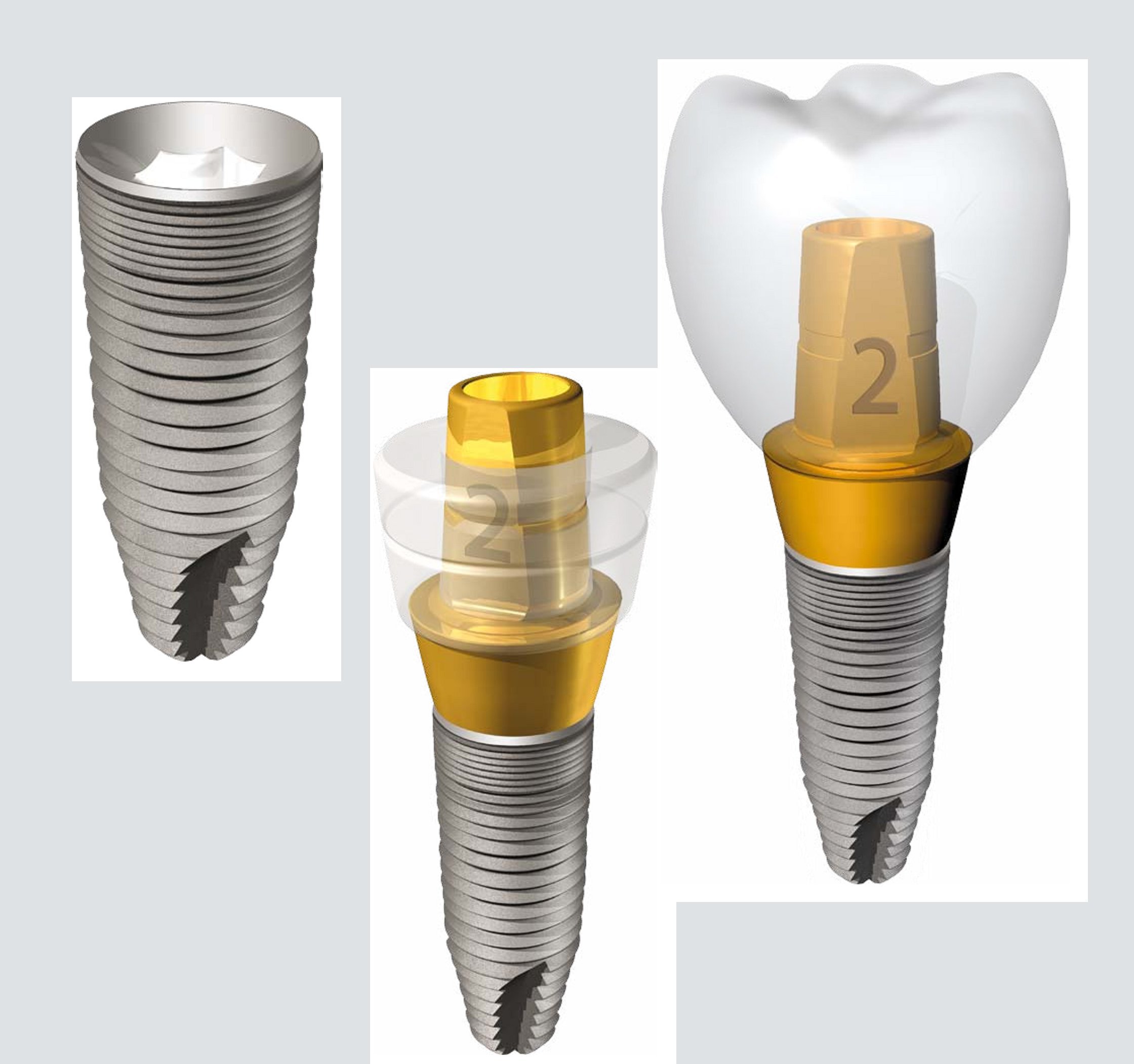 U-Impl Inter Dental Implant | SpotImplant