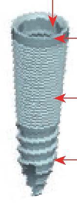 Victory Fratex Internal Octagon (OFX) Implant dentaire | SpotImplant