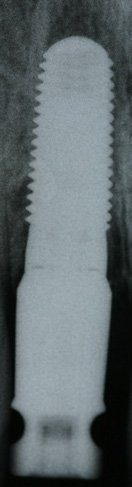 Zimmer-Biomet Tapered Screw-Vent (TSV) Implant dentaire | SpotImplant