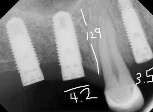 Zimmer-Biomet Tapered Screw-Vent (TSV) Implant dentaire | SpotImplant