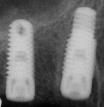 Zimmer-Biomet Tapered Screw-Vent (TSV) Implant dentaire | SpotImplant