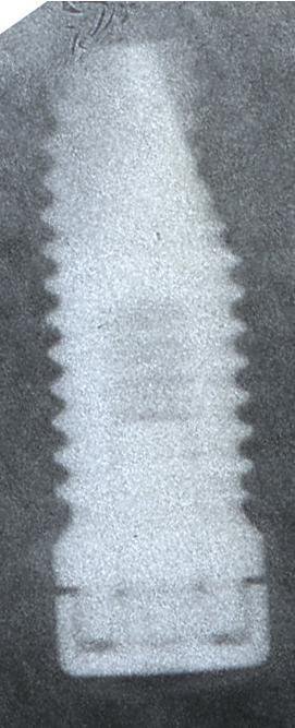 Zimmer Spline Twist Implant dentaire | SpotImplant