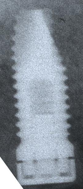 Zimmer Spline Twist Implant dentaire | SpotImplant