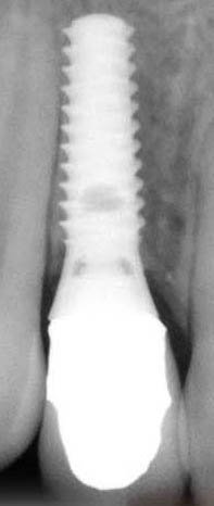 Zimmer SwissPlus Tapered Dental Implant | SpotImplant