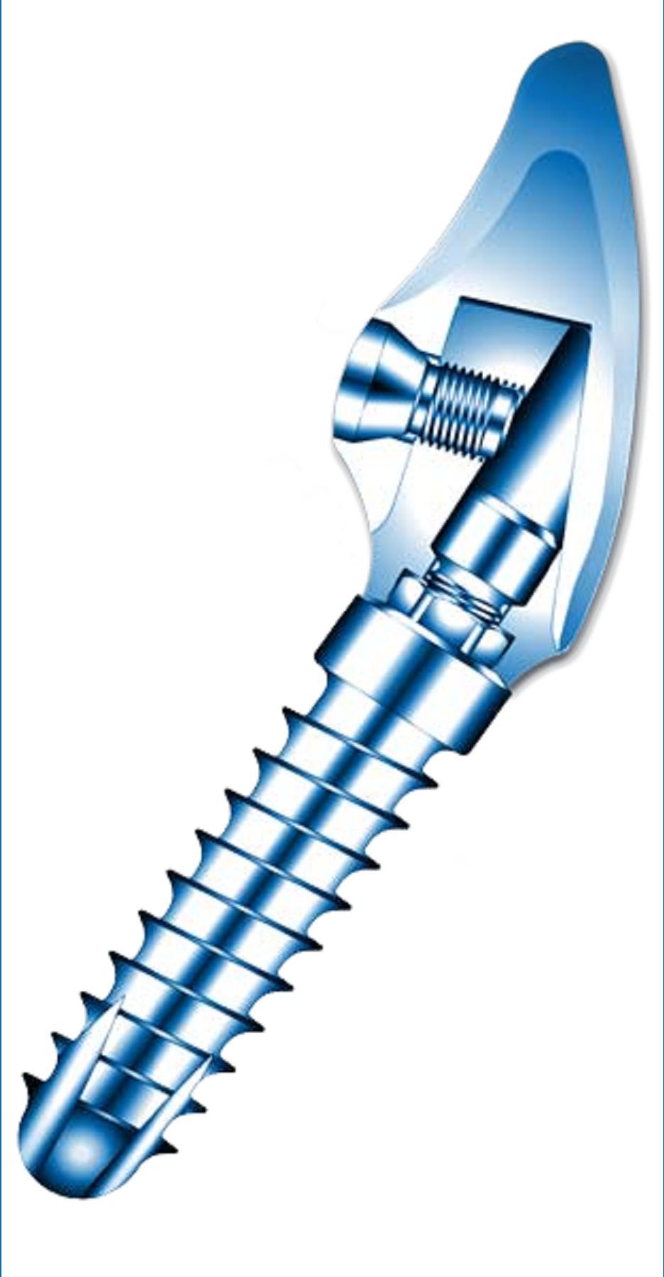 ZL-Microdent Duraplant Dental Implant | SpotImplant